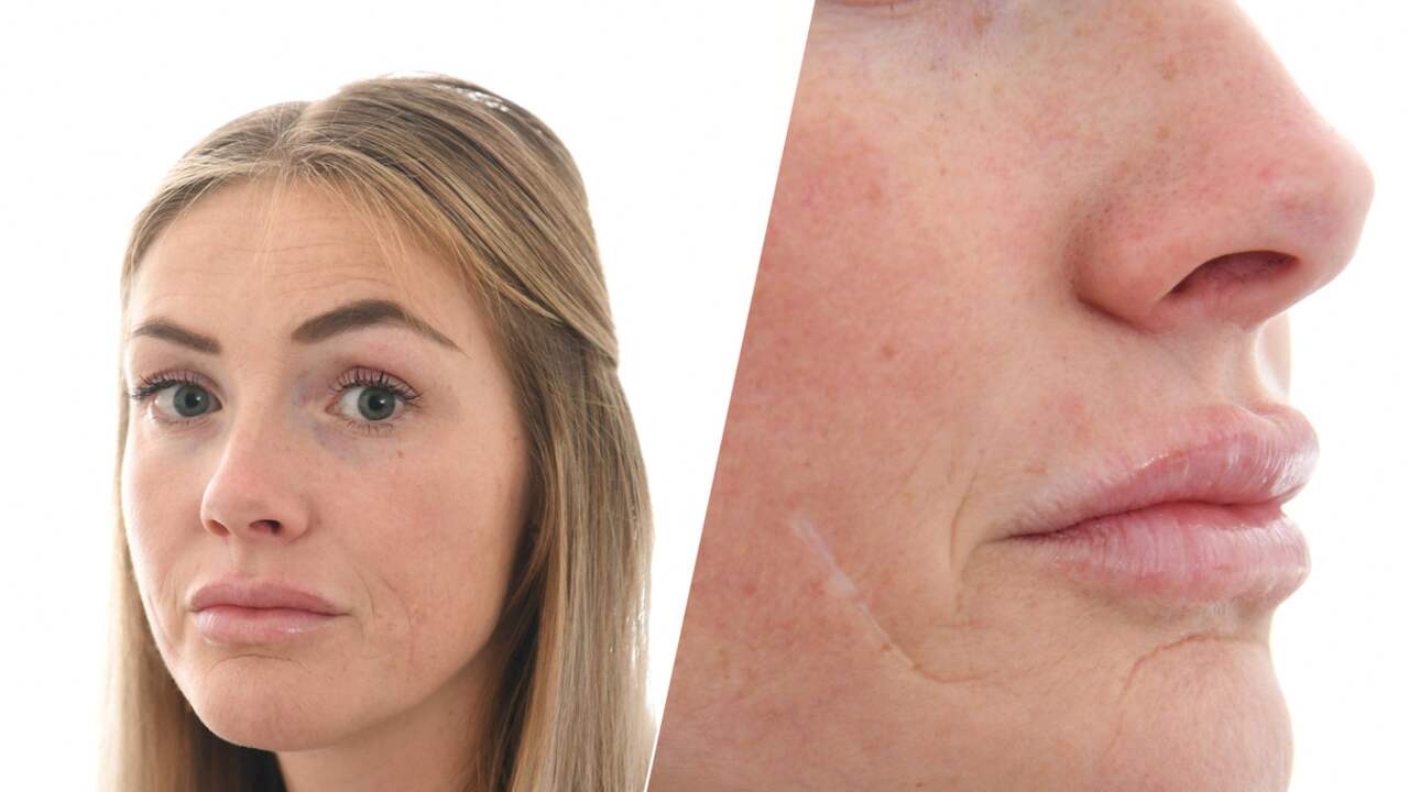 Linde heeft littekens op gezicht door schoonheidsbehandeling | Algemeen ...